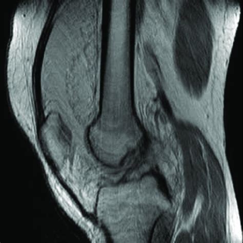Pdf Lipoma Arborescens Of The Knee In A 17 Year Old Man