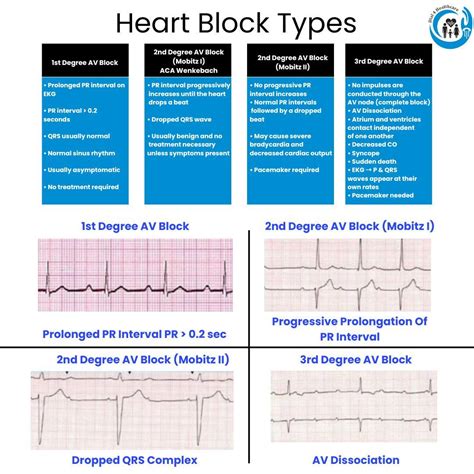 Dial Understanding Heart Block Types And Risks A Heart Block Occurs When The Electrical