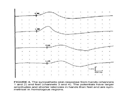 Sympathetic Skin Response Ssr Testing