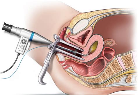 Hysteroscopy Endometrial Cancer