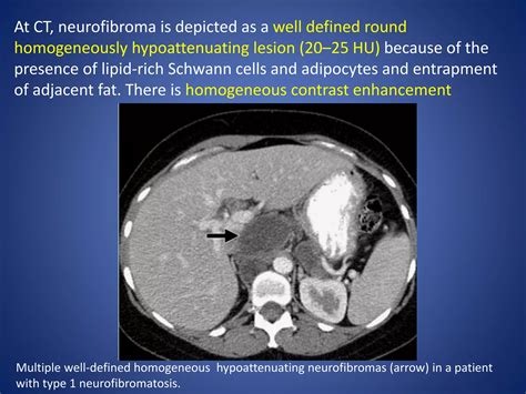 Retroperitoneal Masses Radiology Pptx