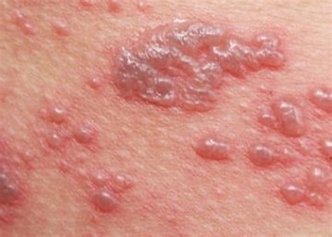 هن معلومات عن الحزام الناري الأعراض وكيفية العلاج