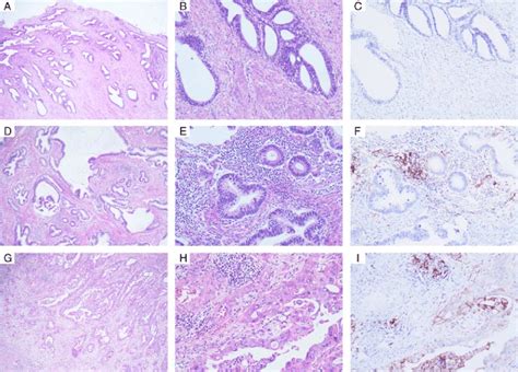 Examples Of Hpva Eca With Different Patterns Of Invasion And Download Scientific Diagram