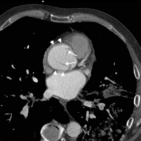Transesophageal Echocardiogram Transesophageal Echocardiographic Scan