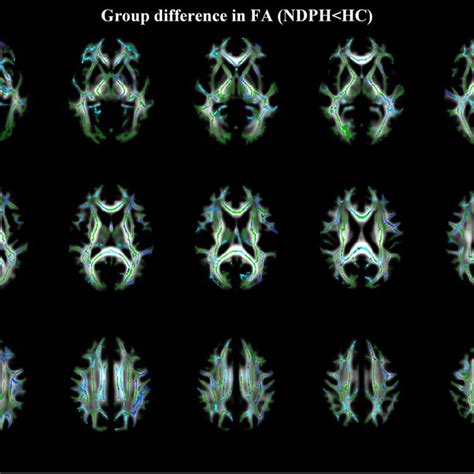 White Matter Regions Blue Showed Decreased Fractional Anisotropy Fa
