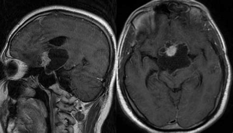 Dr Balaji Anvekar Frcr Craniopharyngioma