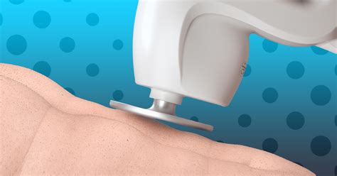 Skin Choice Accent Prime Топене на мастни натрупвания за мъже