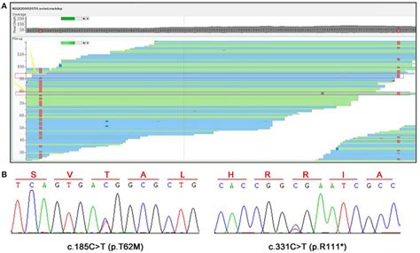 Wes And Sanger Sequencing Results A A Compound Heterozygous Variants