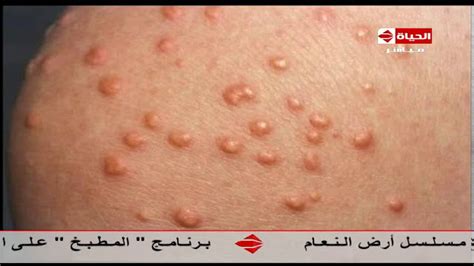 الأمراض الجلدية La Vie Dans Le Monde