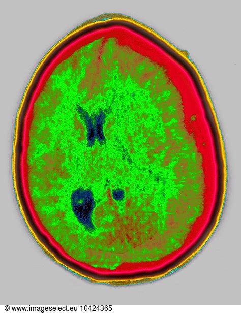Axial Ct Scan Of The Brain Showing A Subdural Hematoma Axial Ct Scan Of