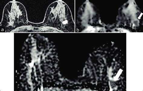 A 53 Year Old Female With Invasive Ductal Carcinoma A Axial