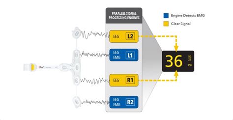 Masimo Sedline® Brain Monitoring