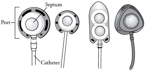 Caring For Your Implanted Port For Pediatric Patients Memorial Sloan