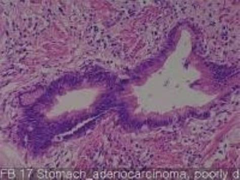 Novus Biologicals™ Stomach Matched Cancer And Normal Tissue Microarray Slide Microarray Novus