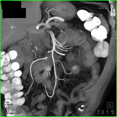 Active Bleed In Jejunal Loop In Patient Seen On Cta Small Bowel Case