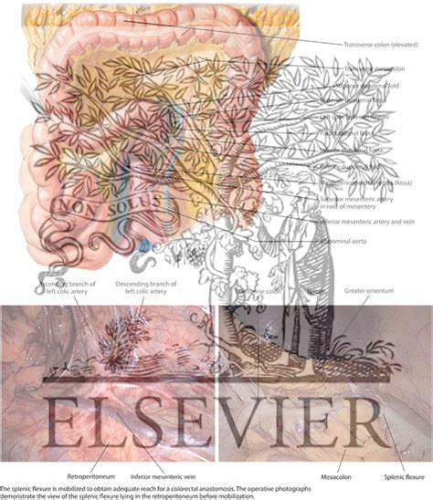 Inferior Mesenteric Vein And Splenic Flexure