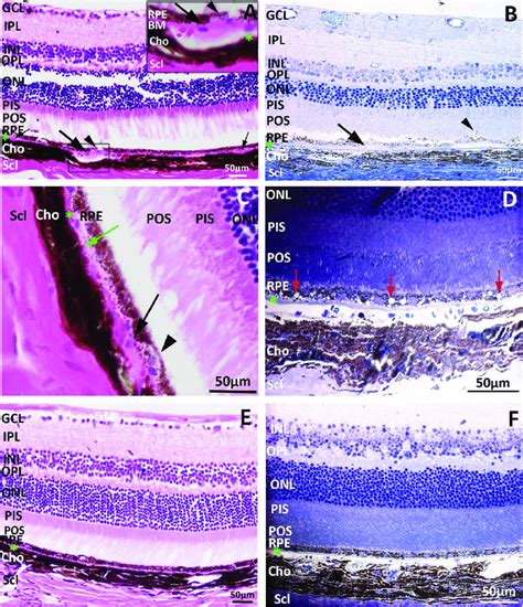 Drusen Like Sub Rpe Deposition And Rpe Vacuolization In Aged