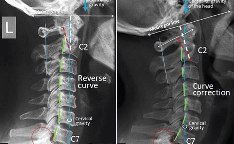 The Importance Of X Rays In Chiropractic Diagnosis Henry Chiropractic