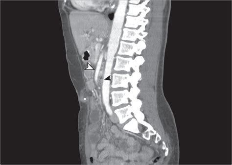 Laparoscopic Management Of Duodenal Obstruction Resulting From Superior
