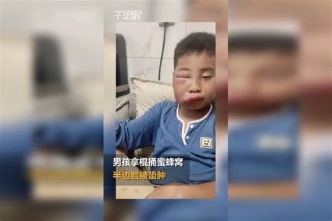 【四川】男孩捅蜂窝被蛰半边脸肿成球半边蜂窝男孩