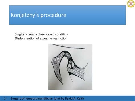Temporomandibular Joint Dislocation Pptx
