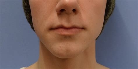 リップリフト（人中短縮術） 男性の症例1か月後一例 Classy 仙台美容外科・美容皮膚科 ブログ