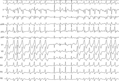 Typical Atrioventricular Bypass Tracts Thoracic Key