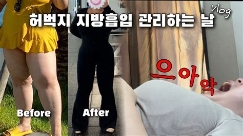 허벅지 지방흡입 관리하는 날 까마귀 주의 🐦‍⬛고도비만 브이로그 헬스 브이로그 허벅지 지흡 Youtube