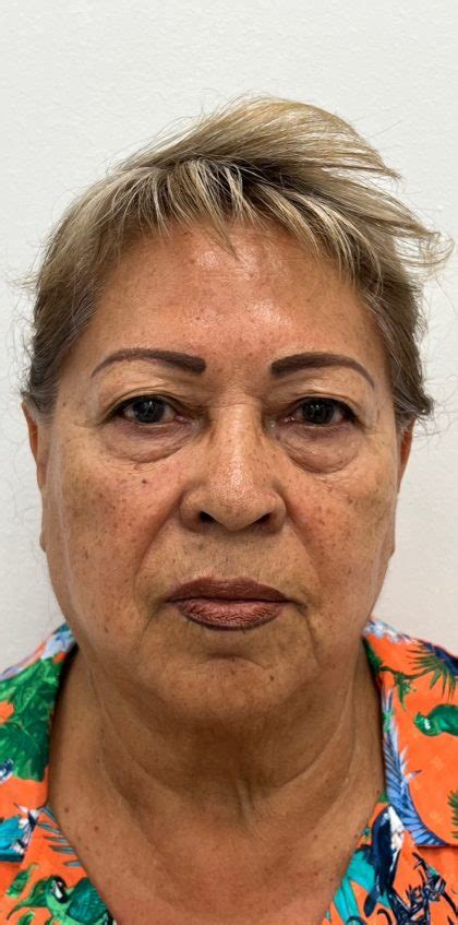 Patient 2987 Lower Blepharoplasty Before And After Photos Alhambra