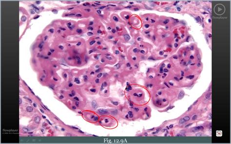 11 Glomerular Disease Flashcards Quizlet