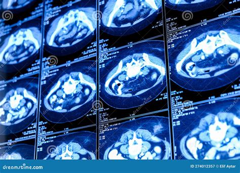 Computed Tomography Ct Scan Of Chest With Abdomen Stock Image