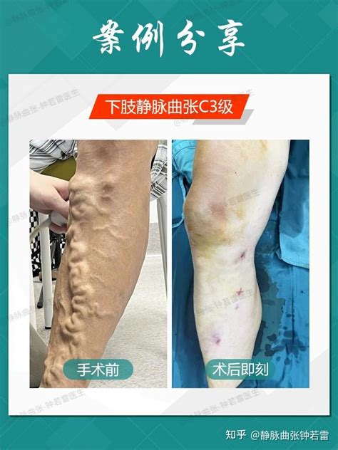 静脉曲张案例四烧烤摊一做20年老爹爹蚯蚓腿盘踞如树根半小时后换腿 知乎