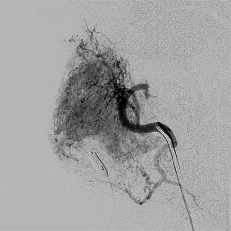 Compva Large Deep Seated Infantile Hemangioma