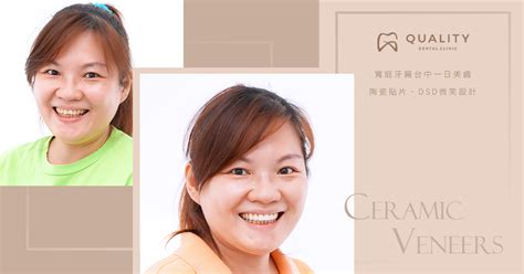 陶瓷貼片客製專屬於你的美麗微笑曲線 顏芳筠醫師案例 寬庭牙醫 台中牙醫推薦 陶瓷美齒貼片 陶瓷貼片