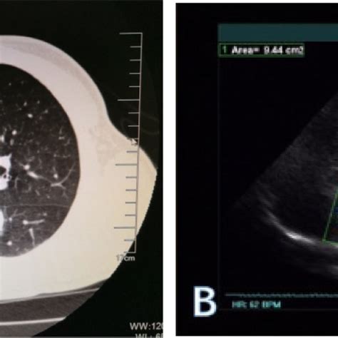A Computed Tomography Imaging Scans Identified A Right Upper Lobe