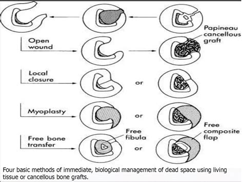 Osteomyelitis Pptx