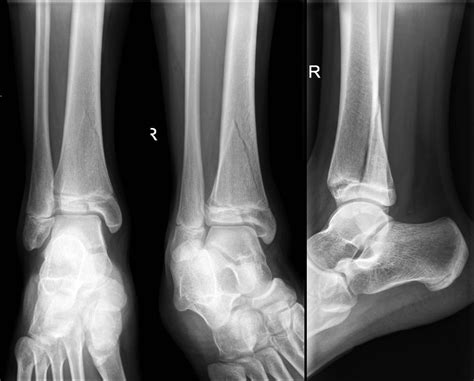 Fractured Fibula Near Ankle