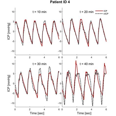 The Non Invasive Icp Waveform Estimate Nicp Interrupted Red Line Is