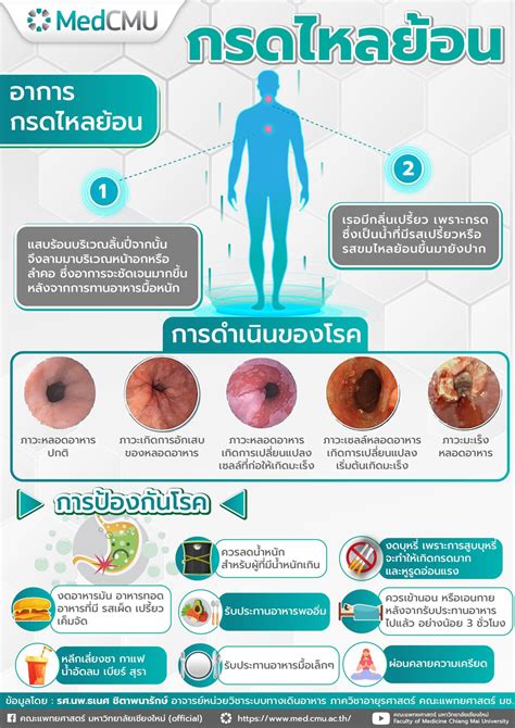 โรคกรดไหลย้อน คณะแพทยศาสตร์ มหาวิทยาลัยเชียงใหม่