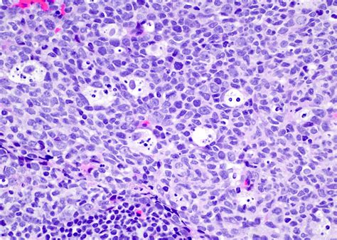 Pathology Outlines Lymphoid Polyp