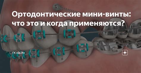 Ортодонтические мини-винты: что это и когда применяются? | ГК «ЦСИ» | Дзен
