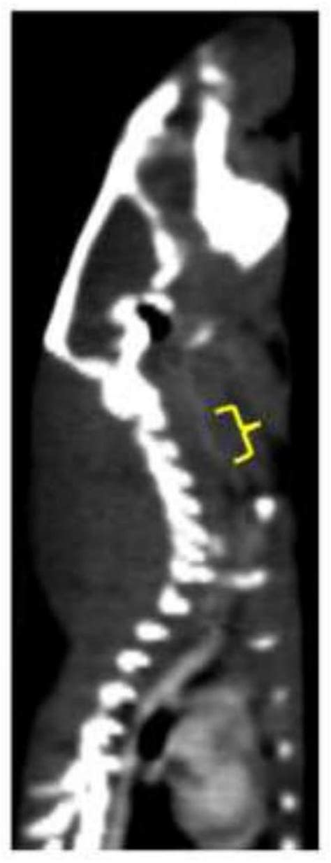 一种人工血管材料及利用其制备的无涂层式一体化抗凝血小口径人工血管 Cn115845147b 专利顾如