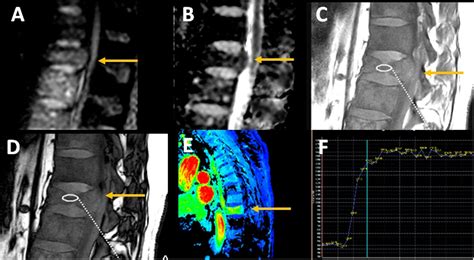 Imaging Of Low Energy Vertebral Fractures Radiología English Edition