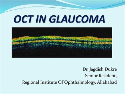 Glaucoma Opthalmology Pptx