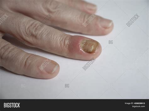 Paronychia Disease Image And Photo Free Trial Bigstock
