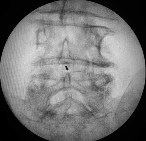Vadim Tashlykov Md Msc Fipp Linkedin‘de Lumbar Xr Guided Epidural