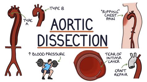 Aortic Dissection Types Sellers