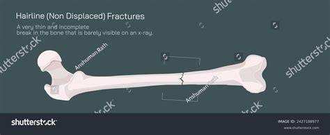 Types Bone Fracture Structure Bone Vector Stock Vector Royalty Free Shutterstock
