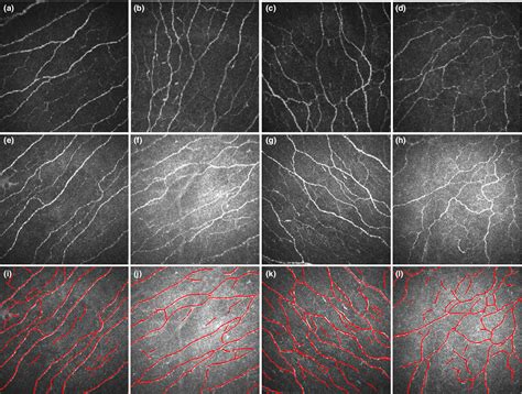 Figure 1 From Corneal Nerve Tortuosity Grading Via Ordered Weighted