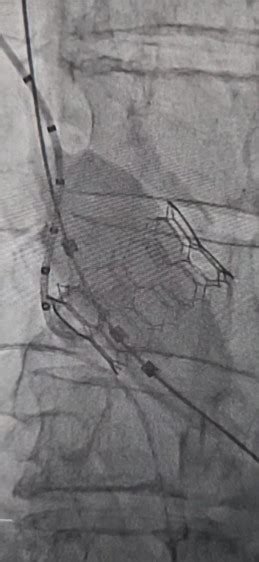 Surgical Supplies Ltd First Myval Octacor Case At Waikato Hospital